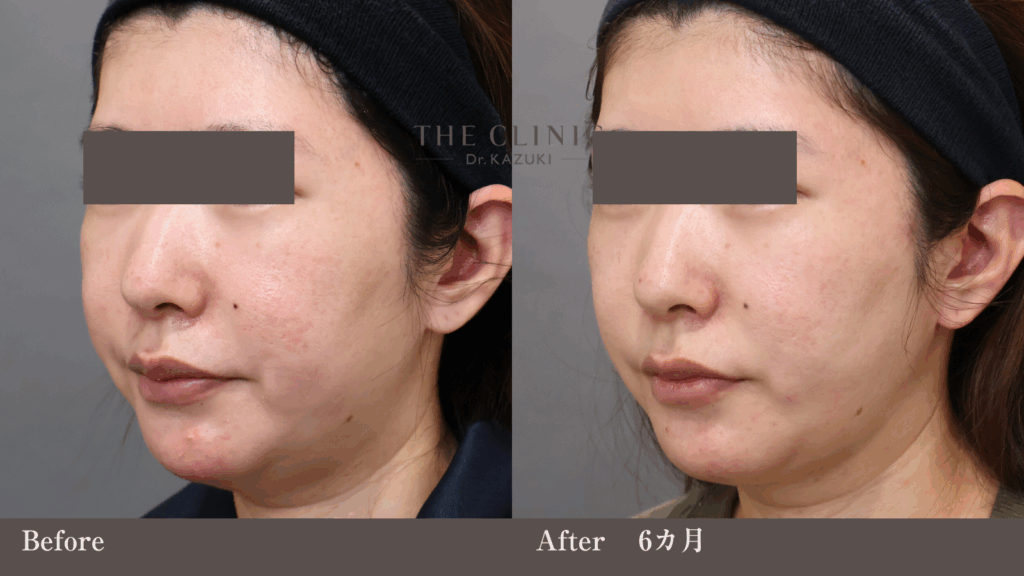 頬顎下 VASER脂肪吸引 VOVリフト 術後6カ月経過 | 加藤和樹 美容外科医ブログ｜脂肪吸引・豊胸・エイジング治療