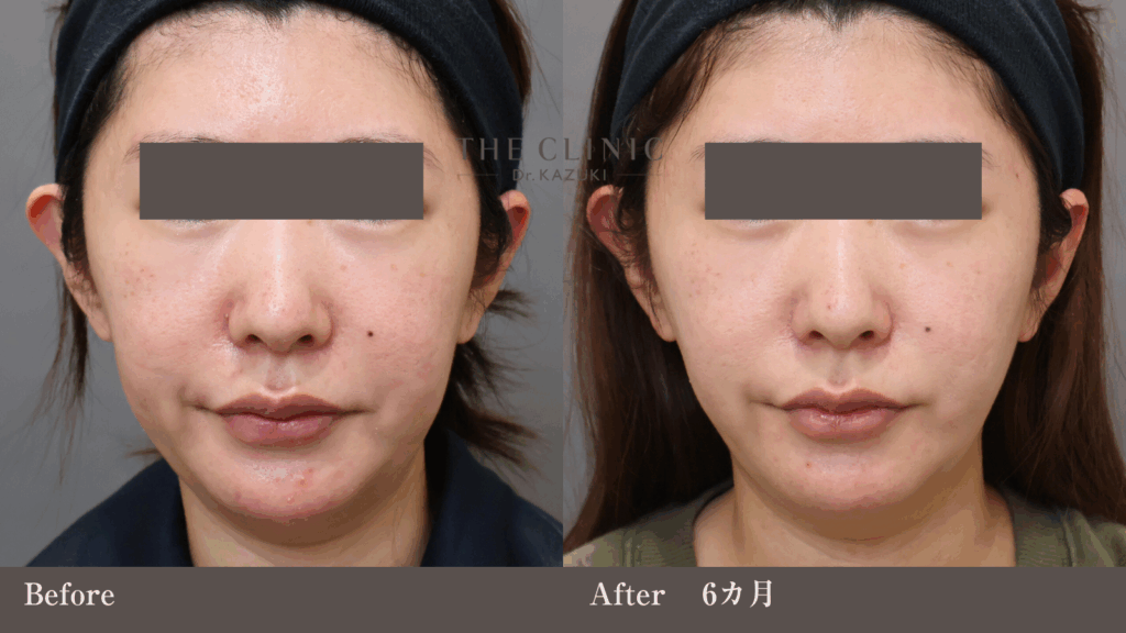 頬顎下 VASER脂肪吸引 VOVリフト 術後6カ月経過 | 加藤和樹 美容外科医ブログ｜脂肪吸引・豊胸・エイジング治療